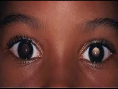 العمى النهاري Hemeralopia | اسباب اعراض علاج | الطبي